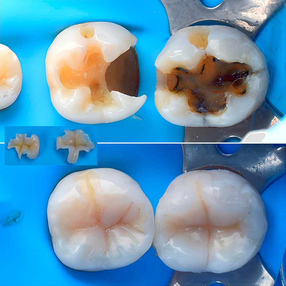 Absolute Isolation Technique and its Importance - Dr. Alejandro Martinez