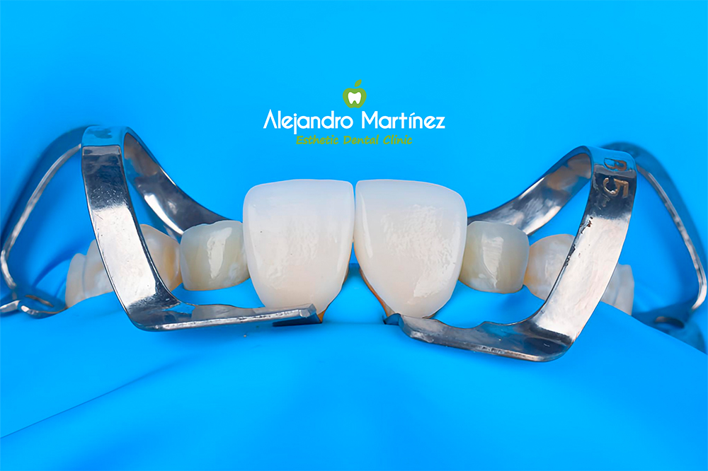 Absolute Isolation Technique and its Importance - Dr. Alejandro Martinez